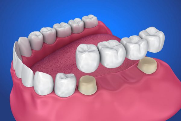 Fixed Bridges - California Dental Care
