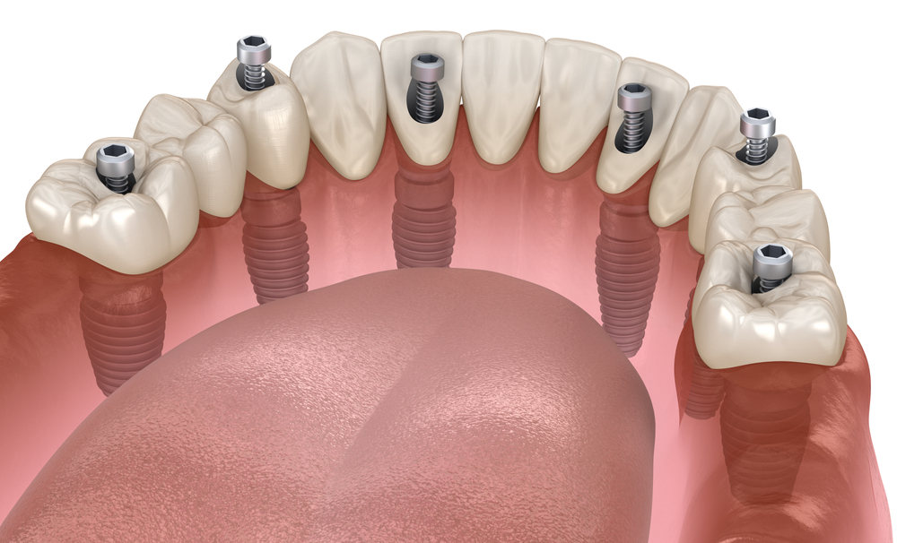 ALL-ON-4® Implant Treatment - California Dental Care