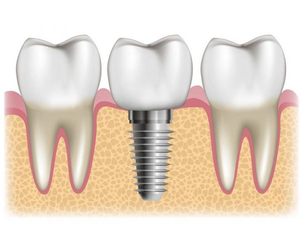 Single Dental Implant - California Dental Care